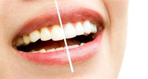 Does Whitening Toothpaste Actually Work Smilogic