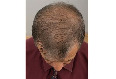 Balding Hairstyles Young Men