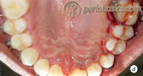 Gingivectomy And Gingivoplasty
