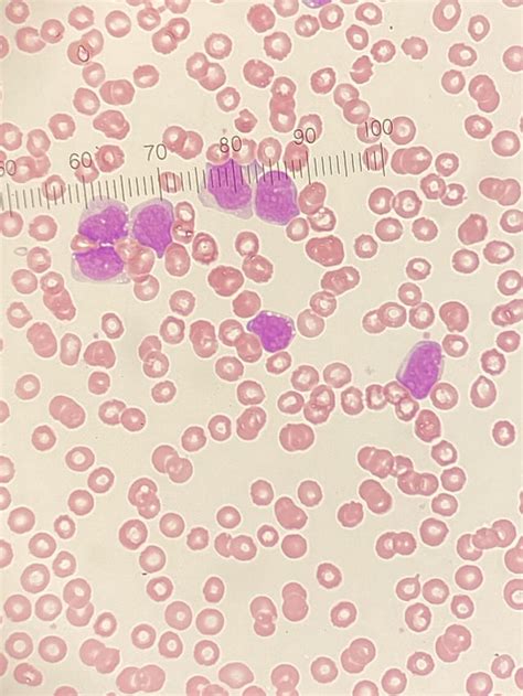 I Always Have A Hard Time With Monos Vs Largereactive Lymphs What