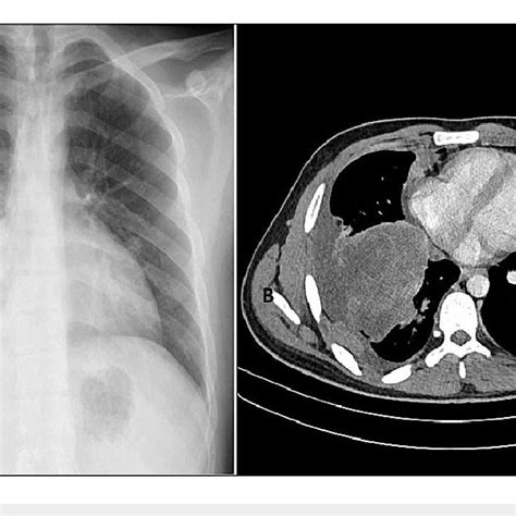 A Chest X Ray Right Middle And Lower Lobe Mass With Rightsided