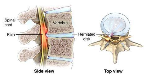 Spinal Cord Compression Vs Spinal Cord Abutment The Chiropractor
