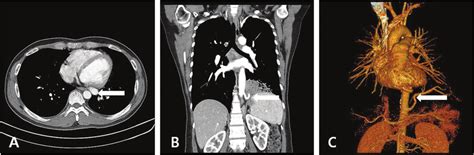 A Computed Tomography Ct Scan Of Patient 1 Showing An Aberrant