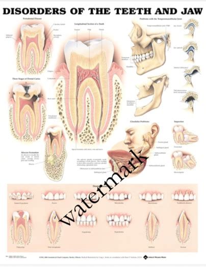 Second Life Marketplace Swe Poster Disorders Of The Teeth
