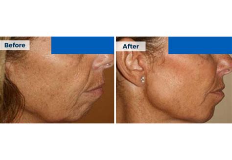 Hifu Ultrasound Skin Tightening National Skin Cancer Centres