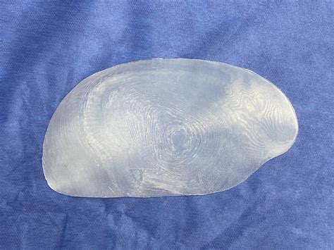 Right Temporal Forehead Implant Intraop Dr Barry Eppley Explore