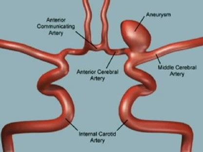 The Basics Cerebral Brain Aneurysms