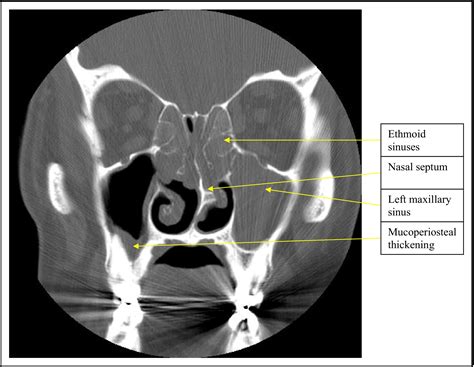 Chronic Rhinosinusitis In Adults The American Journal Of Medicine