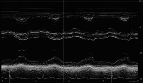 Paradoxical Septal Motion A Diagnostic Approach And Clinical Relevance
