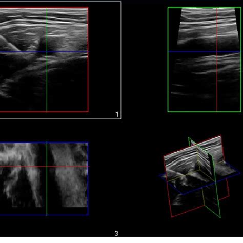 Three Dimensional Us Image Of An Axillary Brachial Plexus Block 1 Download Scientific Diagram