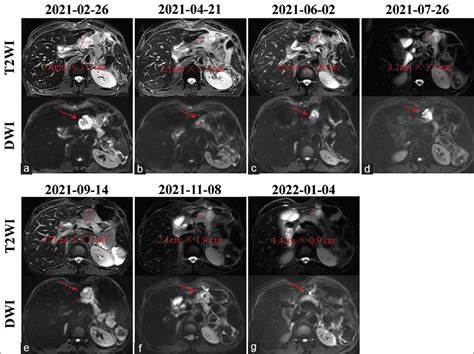 Pseudoprogression During Immunotherapy For Gastric Adenocarc