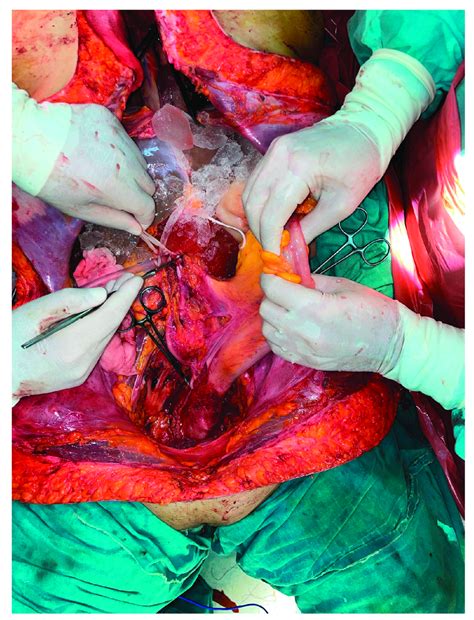 Situs After Removal Of Uterine Graft From Donor The Deep Pelvic