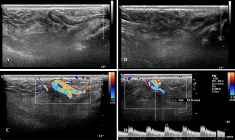 Caliber Persistent Artery In The Facial Structures A Case Report With