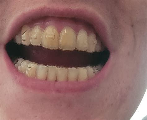 Not Tracking Rinvisalign