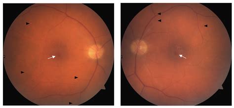 Macular Telangiectasia Type 2 Case Report And Clinical Review