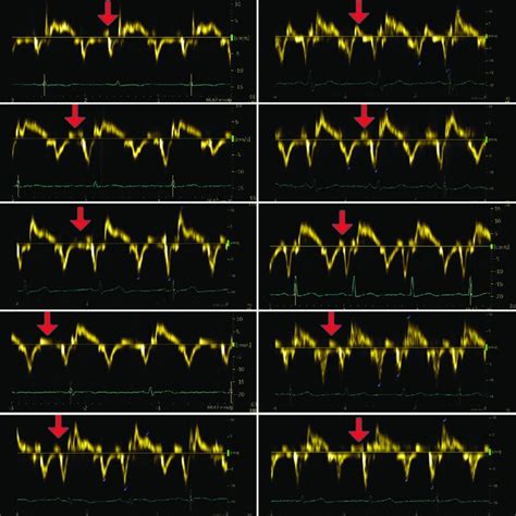 In Sample 10 Patients With Normal Lv Diastolic Function The