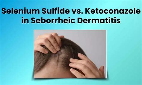 A Comparative Analysis Selenium Sulfide Vs Ketoconazole In Seborrheic