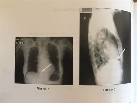 Xrays Of Pericardial Calcification