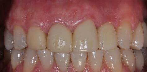 Socket Shield Therapy When Where And How Iti Blog