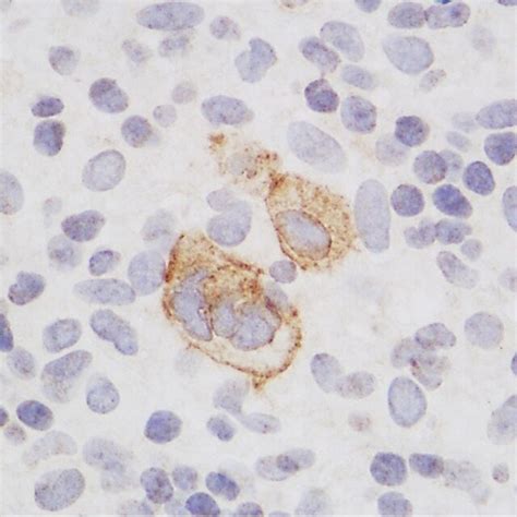 Rt Dlbcl Case With Cd30 Positive Neoplastic Lymphocytes At 100×