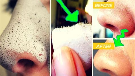 Super Extreme Pimple Popping Compilation Zits And Acne Dermatology