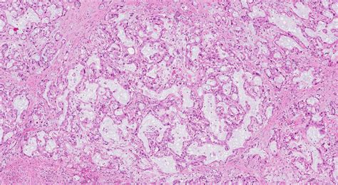 Your Pathology Report For Cholangiocarcinoma Mypathologyreport Your Pathology Report For Cholangiocarcinoma Mypathologyreport