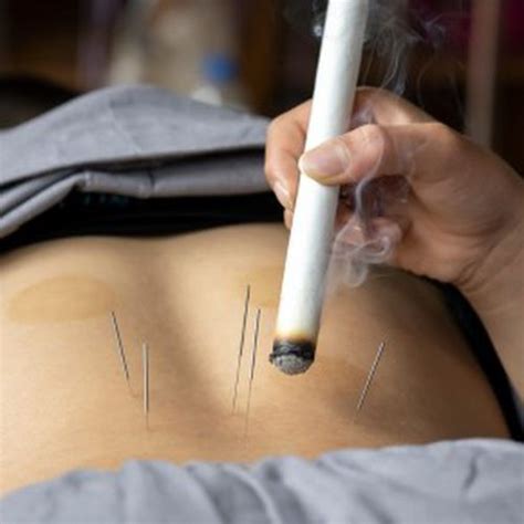 Moxibustion Therapy In Australia Heat For Healing