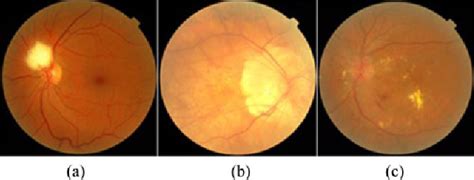 Figure 13 From Fast Localization And Segmentation Of Optic Disk In Retinal Images Using