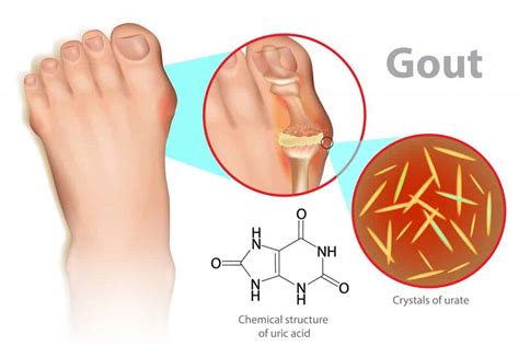 Gout Crystals