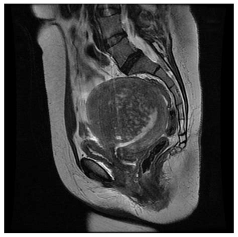 Mri And Adenomyosis What Can Radiologists Evaluate