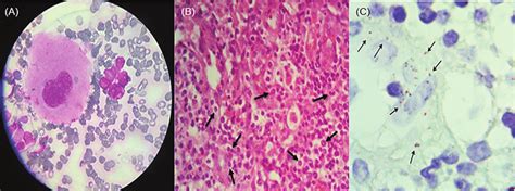 Histopathological Results A Bone Marrow Biopsy Cellularity 70