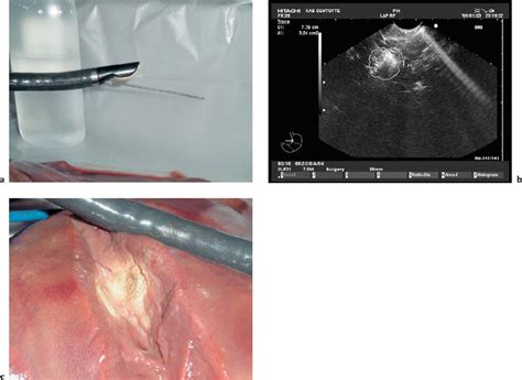 Laparoscopic Ultrasound Scanning Radiology Key