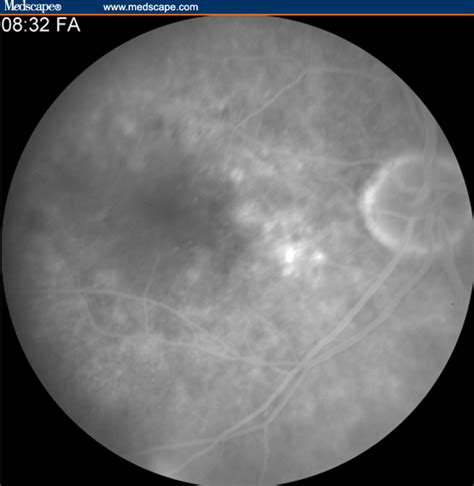 Treatment Strategies For Amd A Review Of 3 Clinical Case Presentations