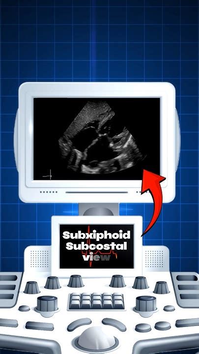 2d Echo Subxiphoid View Explained 🫀📡 Cardiology Echocardiography Youtube 2d Echo Subxiphoid View Explained 🫀📡 Cardiology Echocardiography Youtube