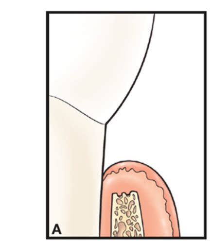 Concepts Fpi M16 Subgingival Calculus Removal Flashcards Quizlet