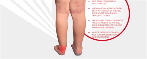Stretches For Severs Disease Sever Disease Treatment Exercises
