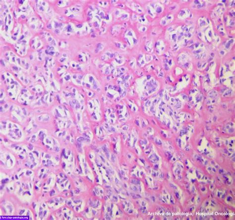 Hombre De 83 Años Con Tumor Vesical Sociedad Latinoamericana De Patología