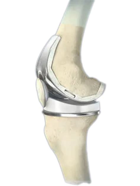 Personalized Knee Replacement With Conformis Mohawk Valley Orthopedic