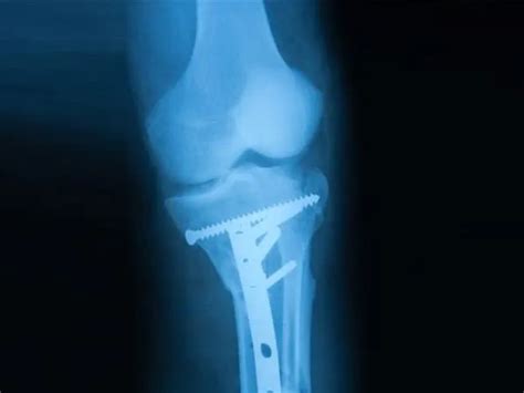 Knee Osteotomy Doctors Appointments