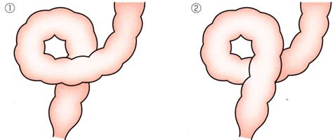 Water Immersion Colonoscopy Technique
