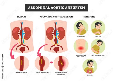 Aortic Tumor Symptoms Angiosarcoma Of The Aorta Yofu