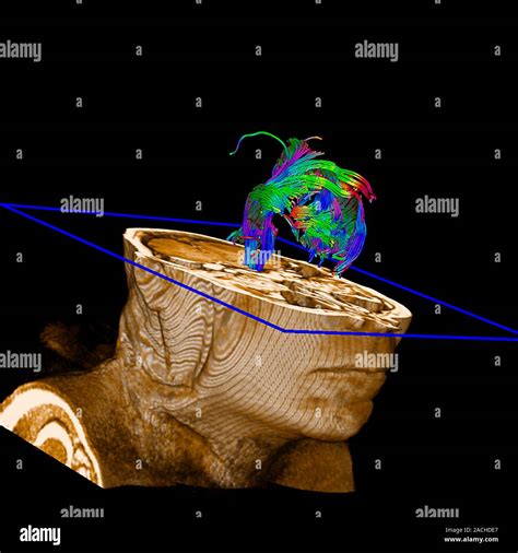 Brain Tumour Coloured 3d Diffusion Tensor Imaging Dti And Magnetic
