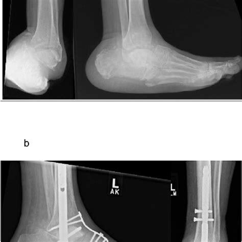 University Of Texas Diabetic Foot Ulcer Classification System