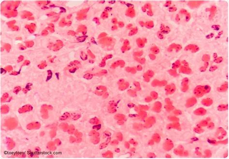 Gram Negative Diplococci