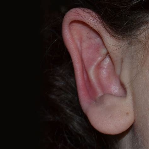 Revision Otoplasty Ear Reconstruction