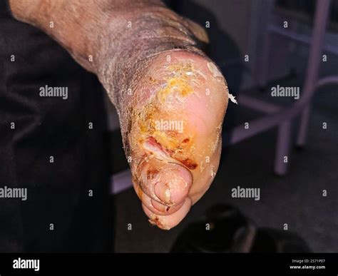 Diabetic Right Foot With Previously Amputated Big Toe Hallux And