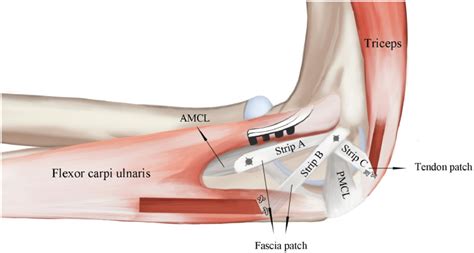 Effectiveness And Safety Of A Less Invasive Mcl Reconstruction