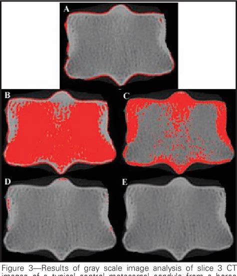 Figure 1 From Subchondral Bone Density And Cartilage Degeneration