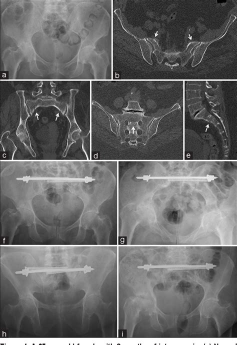 Figure 2 From When And How To Operate Fragility Fractures Of The Pelvis