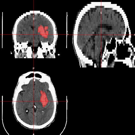 Automated Intracerebral Hemorrhage Segmentation Of Ct Scans